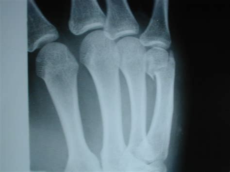 Unidad Cirugia De Mano Y Reconstructiva La Plata Argentina Fractura De 5to Metacarpiano