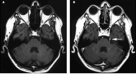 Figure 2 From Incidence Of Enhancement Of The Trigeminal Nerve On Mri In Patients With Multiple