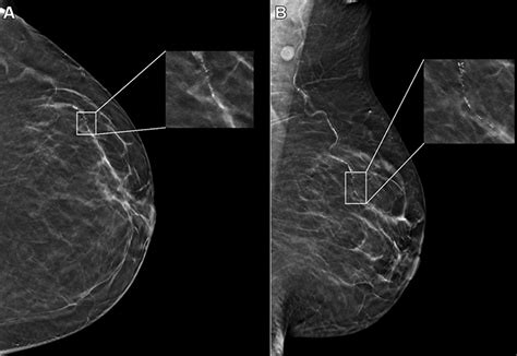 Ai Performance On Digital Mammograms Rsna