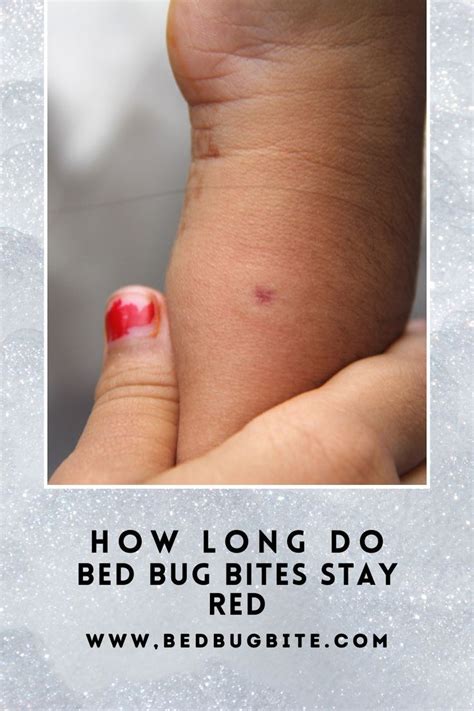 How Long Do Bed Bug Bites Stay Red Bed Bug Bites Bed Bug Bites Remedies Bed Bugs