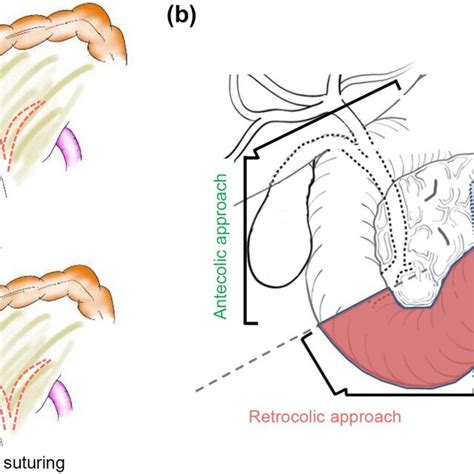 Scheme Of Retrocolic Approach And Proper Use According To Tumor