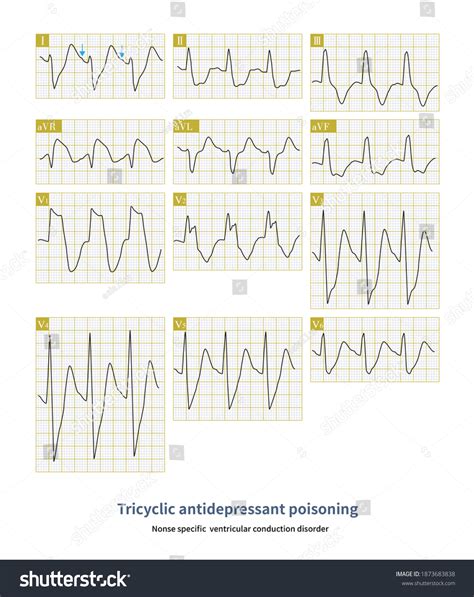 Hyperkalemia Over 45 Royalty Free Licensable Stock Illustrations