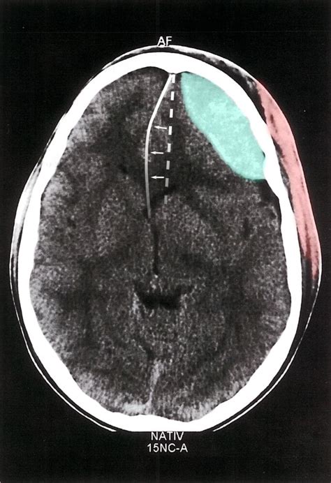 Acute Epidural Hematoma Treatment