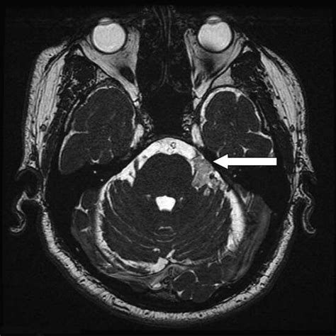 Mri Trigeminal Neuralgia Protocol Test Price In Delhi Ganesh Diagnostic
