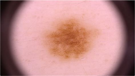 Brownish Macula On Dermoscopy Showing A Typical Reticular Pattern