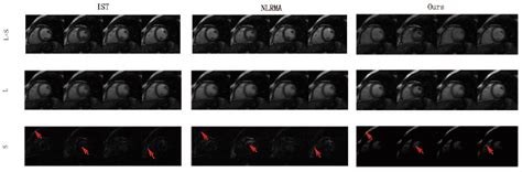 Figure 2 From A Fast Low Rank Matrix Factorization Method For Dynamic Magnetic Resonance Imaging