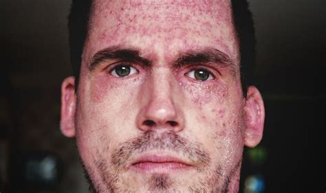 ‘chilly Sign You Could Have Shingles And Other Symptoms More Than Just A Rash Uk