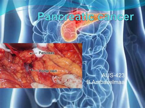 Pancreatic Cancer Нойр булчирхайн хорт хавдар Pptx