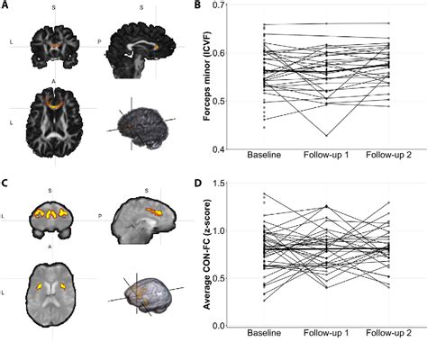 Table 1 From Subjective Cognitive Decline Predicts Lower Cingulo Opercular Network Functional