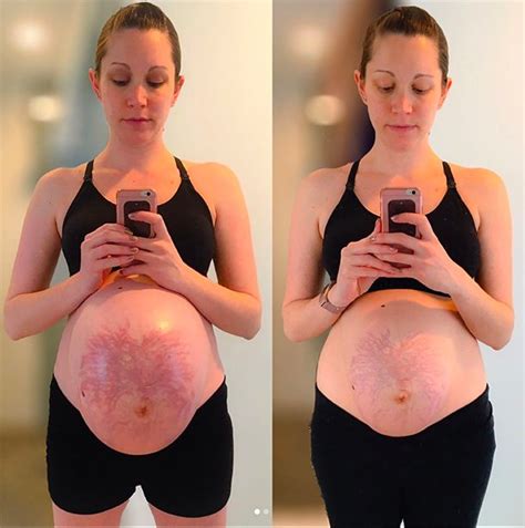 Learn The Truth Behind Stomach Stretch Mark Tattoos