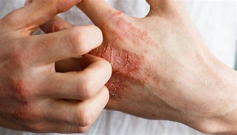 Витамин в6 за какво помага Липса на витамин в6