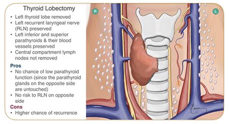 Minimally Invasive Thyroidectomy Larian Md