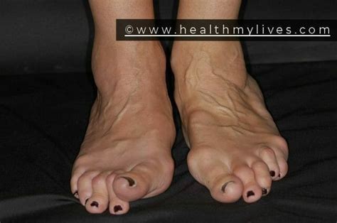 Rheumatoid Arthritis Symptoms Causes Treatments And Diagnosis