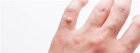 Warts On Hands And Fingers Holland And Barrett