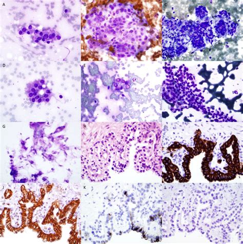 Morphology And Immunohistochemical Results Of Clear Cell Papillary Download Scientific Diagram