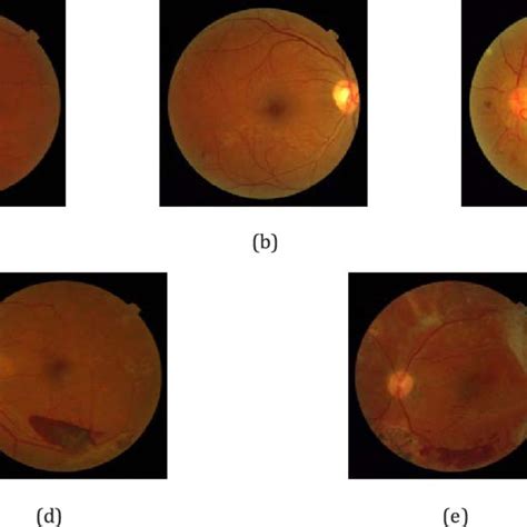 pdf automatic detection of diabetic retinopathy in retinal fundus