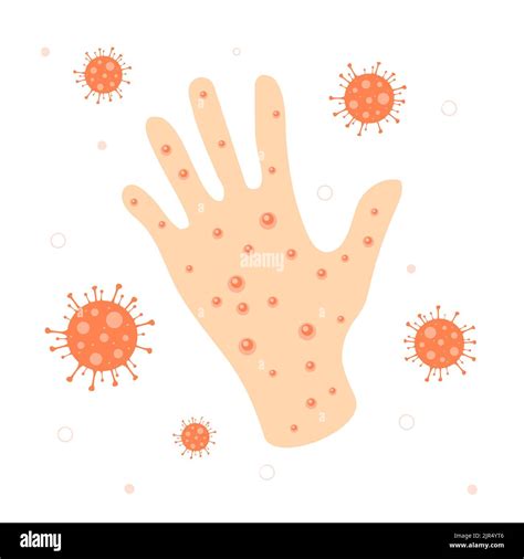 Acne On The Hand From Monkeypox Stock Vector Image And Art Alamy