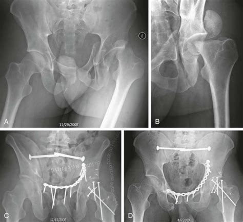 Intracapsular Hip Fractures Musculoskeletal Key