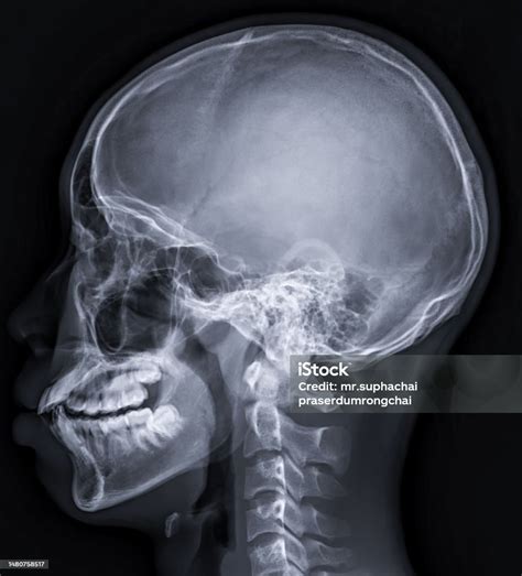Lateral Skull X Ray Anatomy Film X Ray Skull Image And Photo Free