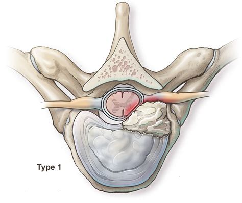What Is Minimally Invasive Lateral Thoracic Discectomy Barrow