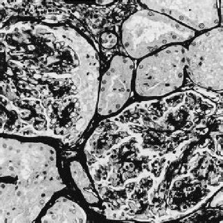 Light Microscopic Findings Showing A Lobular Appearance Of Glomeruli Download Scientific