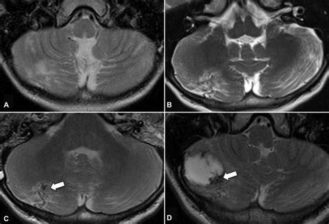 A 2 Year Old Male With Tuberous Sclerosis Complex A T2 Weighted