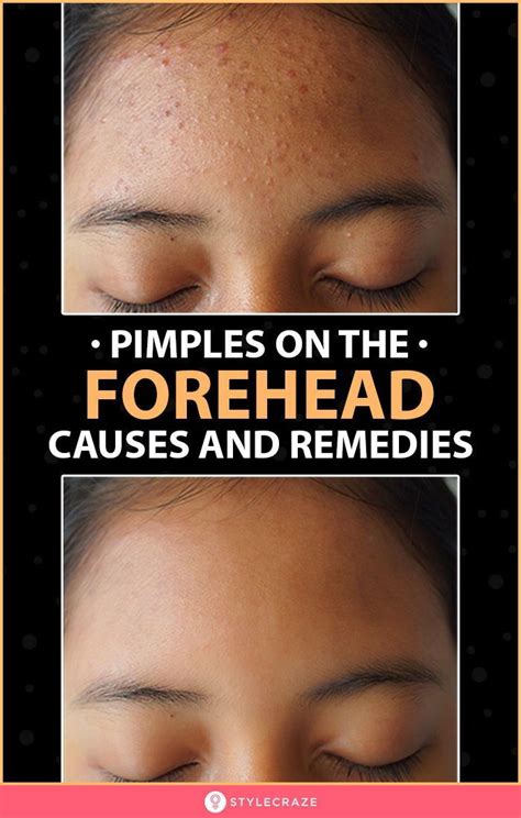 How To Get Rid Of Pimples On Forehead