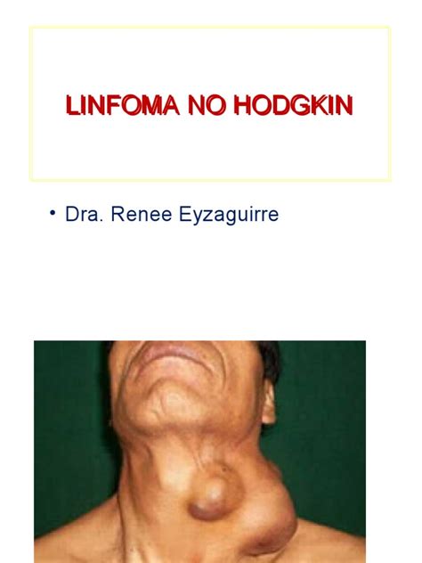 Linfoma No Hodgkin Linfoma No Hodgkin Dra Renee Eyzaguirre Pdf