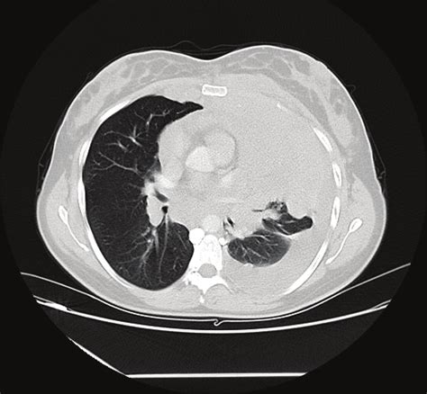 Computerized Tomography Scan At The Time Of Diagnosis Download Scientific Diagram