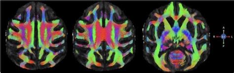 Brain Connections Mndrive Brain Conditions