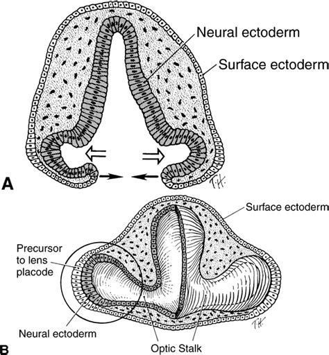 Lens Placode Embryology Pathology Ento Key A Thickened Portion Of