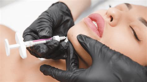 Marionette Lines Filler Gone Wrong Causes Signs And Solutions