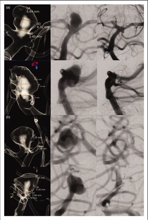 Figure 1 From Semi Automated Cerebral Aneurysm Segmentation And Geometric Analysis For Web