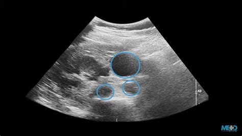 What Are Cholecystitis And Acalculous Cholecystitis Cholecystitis