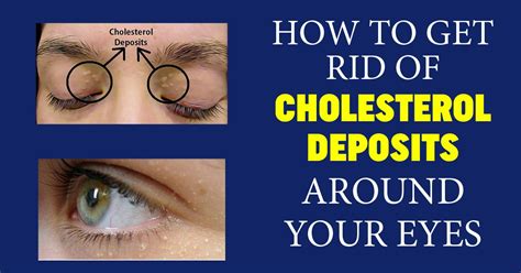 Can You See Cholesterol In Your Eyes At Norma Cameron Blog