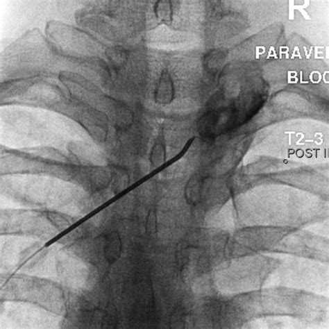 Pdf Epidural Approach To Paravertebral Thoracic Sympathetic Block As An Alternative To