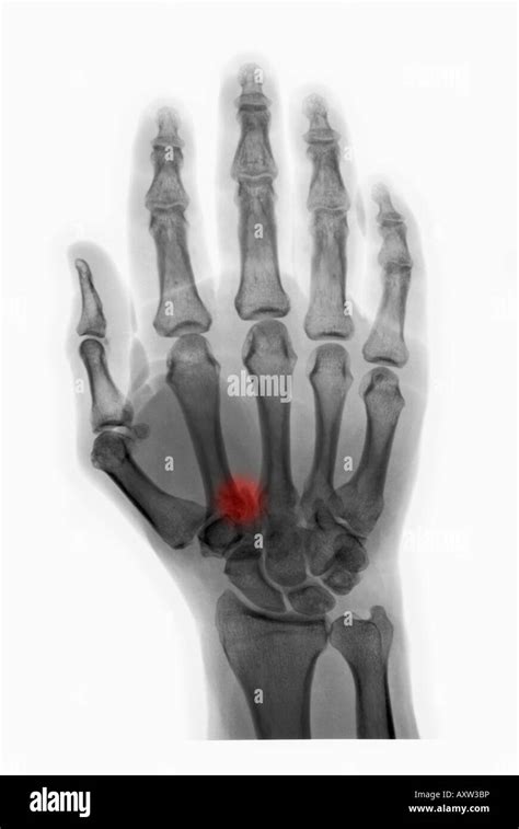 Metacarpal Fracture High Resolution Stock Photography And Images Alamy