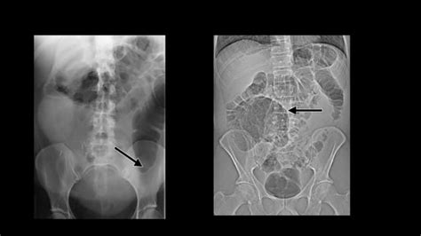 Sigmoid Volvulus Pptxerrtyiioppknjiopplmnnbvgffdd Ppt
