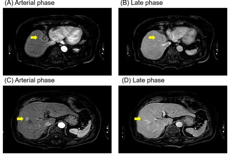 Figure 2 From A Rare Case Of Synchronous Double Primary Hepatocellular Carcinoma And