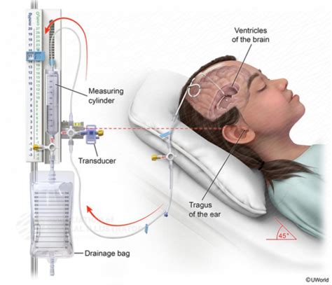 Icp Monitoring Flashcards Quizlet