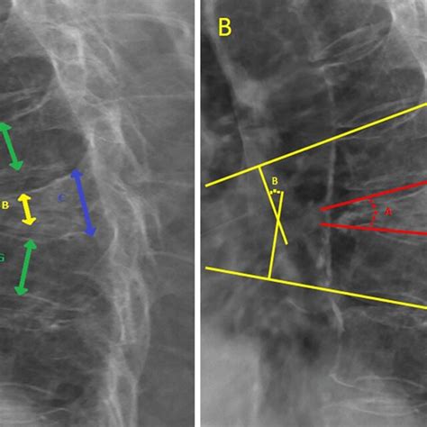 Demonstrated Radiographic Parameters A Evaluation Of The Severity Of