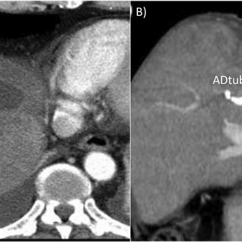 A Delayed Liver Abscess Developed In Segment 7 Arrow Which Caused