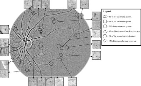 Figure 5 From Automatic Detection Of Red Lesions In Digital Color