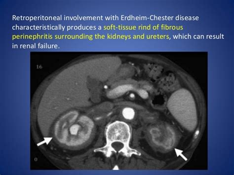 Retroperitoneal Masses Radiology