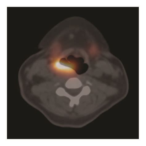 Spect Ct Images From The Second Tc99m Pertechnetate Thyroid Scan A Download Scientific