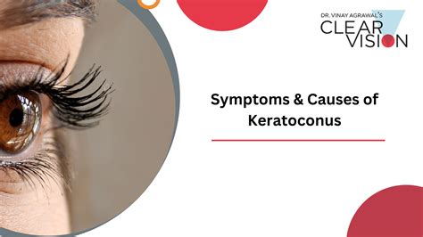 Symptoms Keratoconus And Causes Of Keratoconus