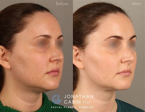What Is Buccal Fat Removal Cabinmd Facial Plastics And Aesthetics