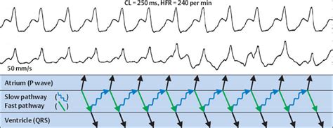 Reentry Tachycardia Thoracic Key