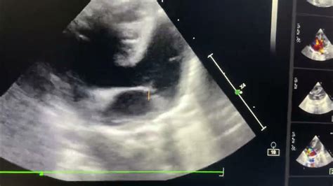 Left Atrial Isomerism Av Discordance Youtube