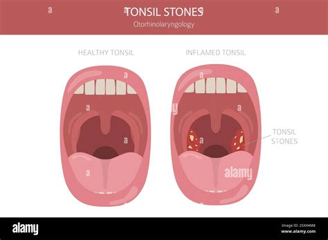 Tonsil Stones Diseases Otorhinolaryngology Chronic Caseous Tonsillitis Medical Infographic
